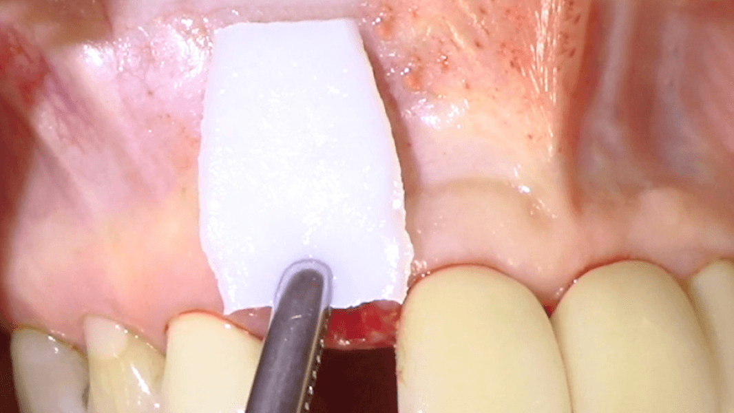 Camlog Biomaterial Weichgewebe Regeneration NovoMatrix