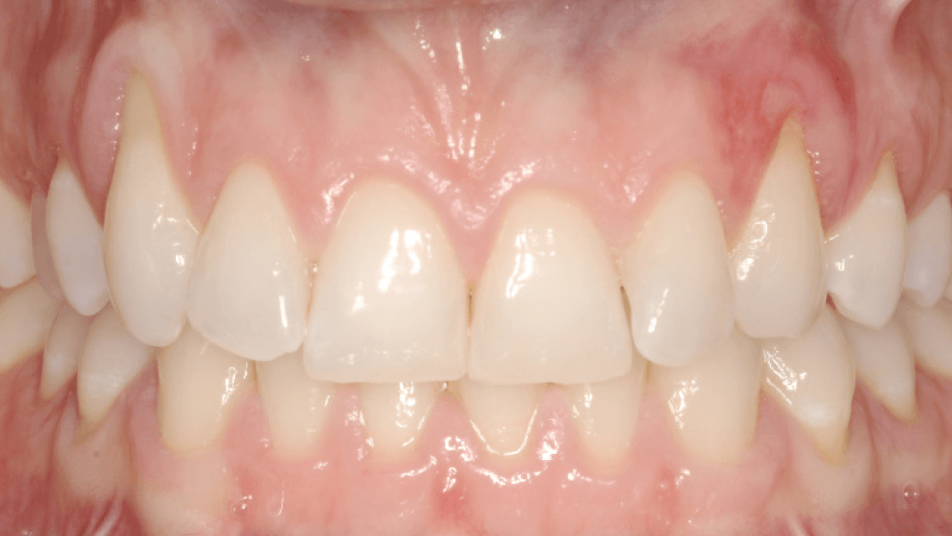 Camlog Biomaterial Weichgewebe Regeneration NovoMatrix