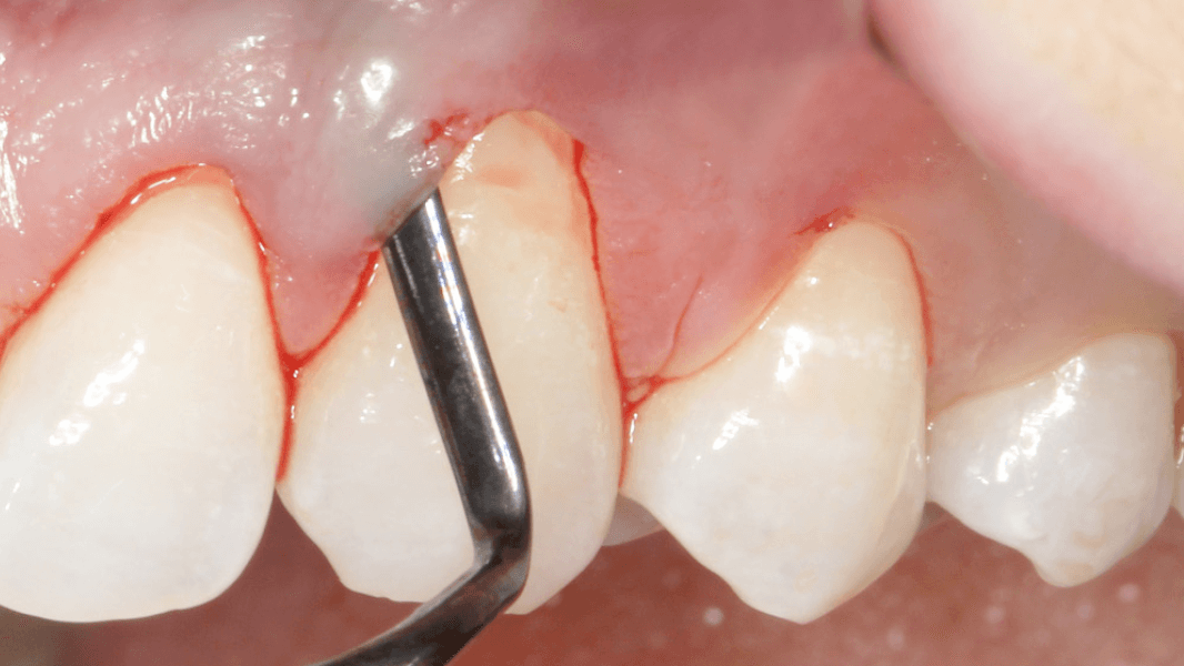 Camlog Biomaterial Weichgewebe Regeneration NovoMatrix
