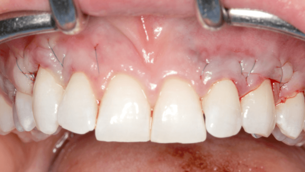 Camlog Biomaterial Weichgewebe Regeneration NovoMatrix
