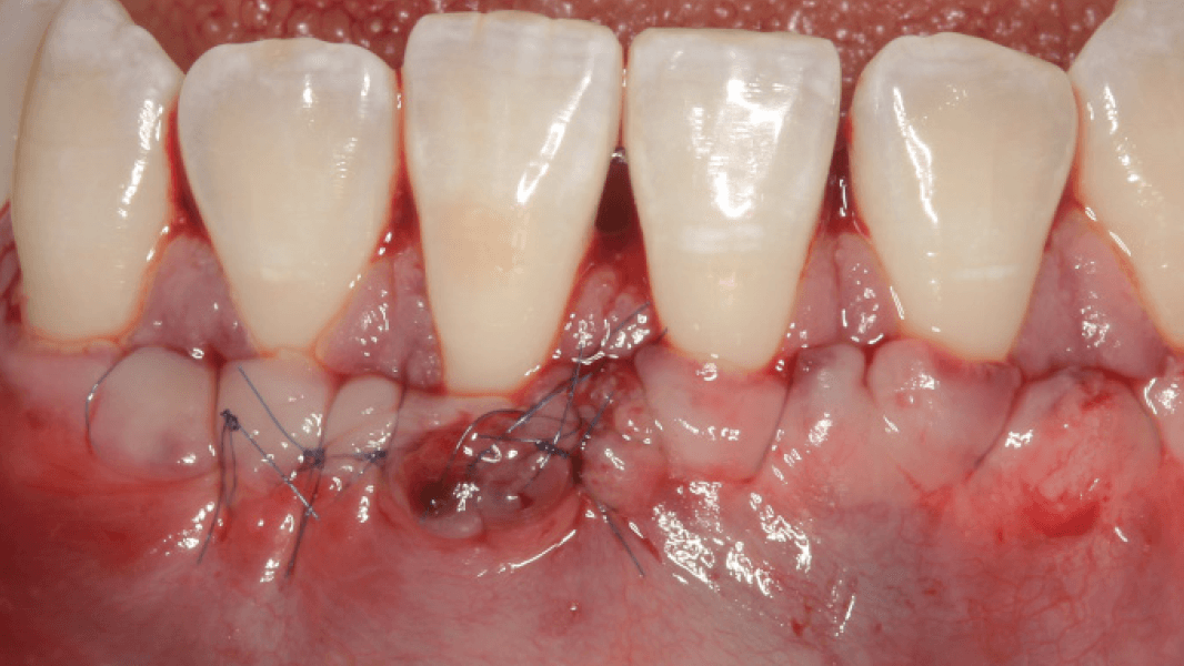 Camlog Biomaterial Weichgewebe Regeneration NovoMatrix