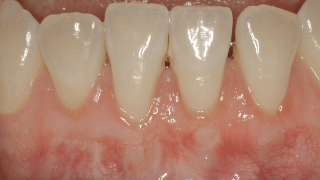 Camlog Biomaterial Weichgewebe Regeneration NovoMatrix