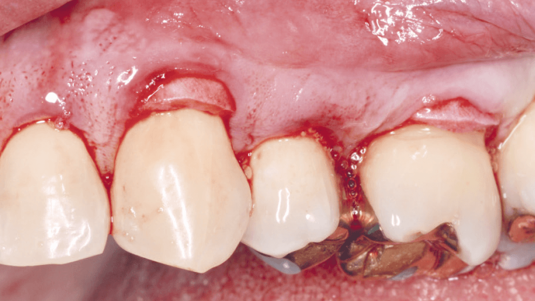 Camlog Biomaterial Weichgewebe Regeneration NovoMatrix